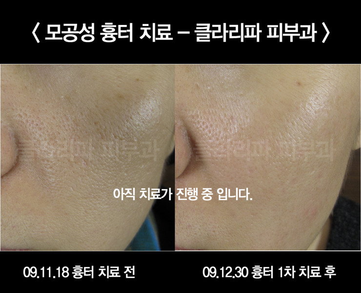 모공성 흉터 치료 중 비교 사진 수술 레이저박피 클라리파 피부과 네이버 블로그