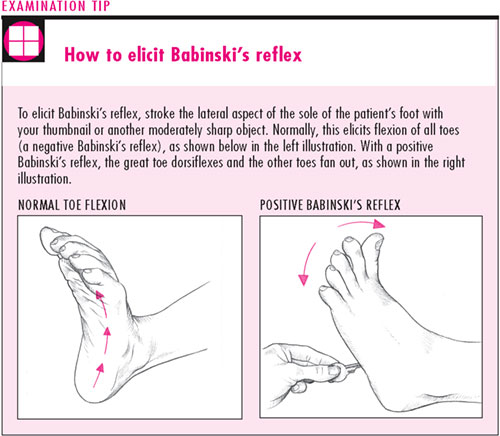 Deep tendon reflex & babinski sign, reflex arc : 네이버 블로그
