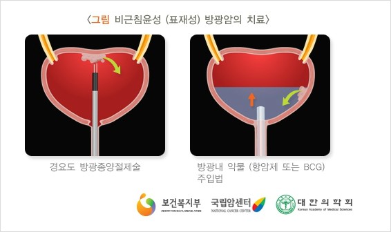 방광암 치료 Bcg결핵균 치료 후기 네이버 블로그