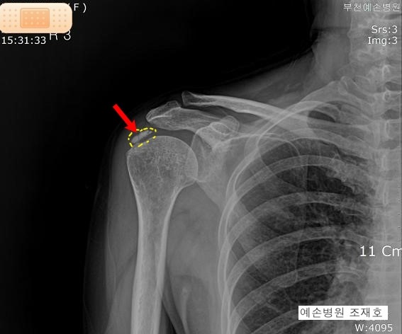 어깨의 회전근개 파열과 동반된 석회성 힘줄염에서 관절경적 석회 제거술 및 회전근개 봉합술 Arthroscopic Rotator