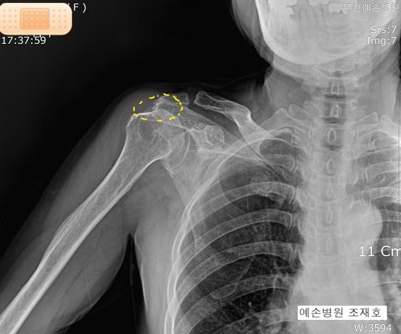 봉합 불가능한 회전근개 파열회전근개 광범위파열에서의 역행성 견관절치환술어깨인공관절reverse Total Shoulder