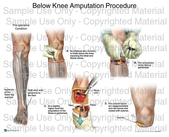 BK(Below Knee) amputation : 네이버 블로그