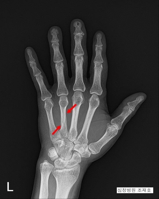 중수골의 사선형 골절에서의 관혈적 정복술 및 내고정술 Orif At Metacarpal Oblique Fracture올바른
