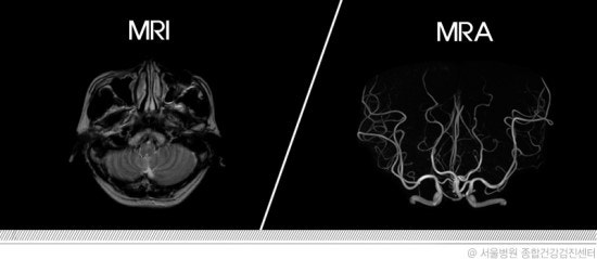 MRI검사와 MRA검사의 차이는 뭘까? : 네이버 블로그