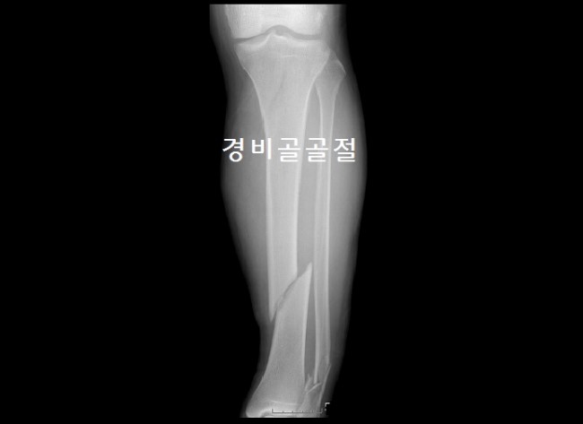 정강이뼈 골절 보상사례 경골골절 경비골골절 네이버 블로그