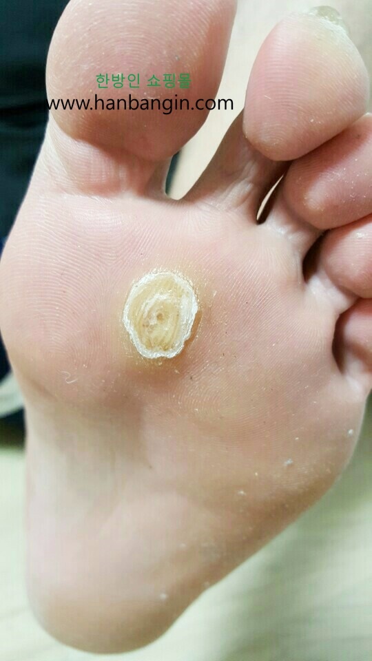 [발바닥티눈]티눈제거방법 네이버 블로그