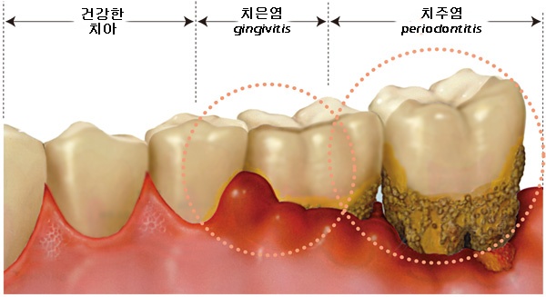 치주염과 치은염 네이버 블로그