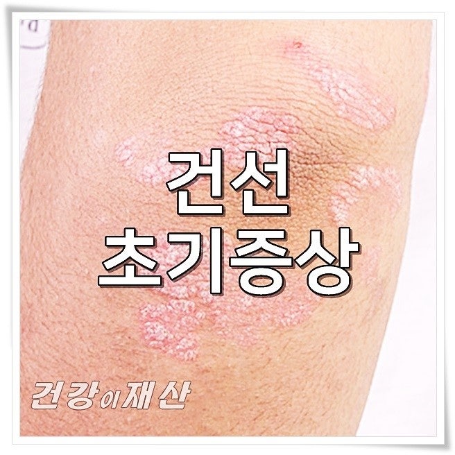건선 초기증상 빨간 피부트러블 네이버 블로그