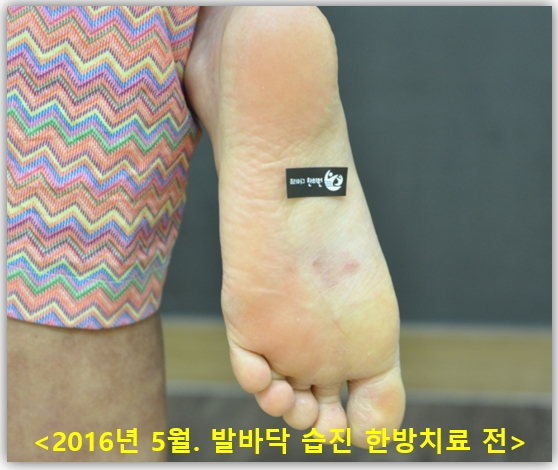 발바닥습진 발백선증무좀과의 감별 And 원인 알아보기 네이버 블로그