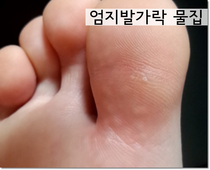엄지발가락 물집 발바닥에 오돌토돌 수포들 싹 없앤 후기 네이버 블로그