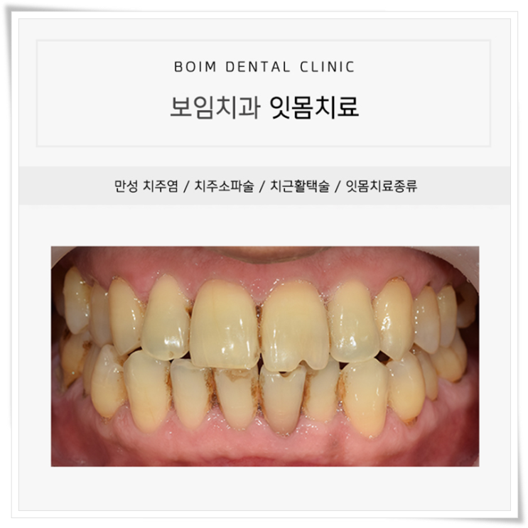 만성 치주염 치료 잇몸치료종류스케일링치근활택술치주소파술 네이버 블로그